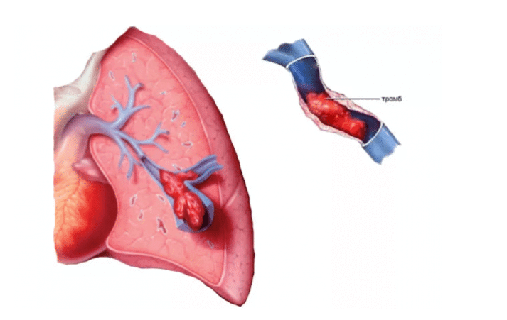 Liposuction Komplikasyonları - Op. Dr. Leyla Arvas