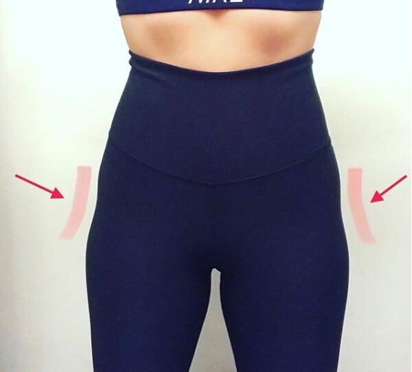 Hip Dips Nedir? | 2025 Fiyatları - Op. Dr. Leyla Arvas