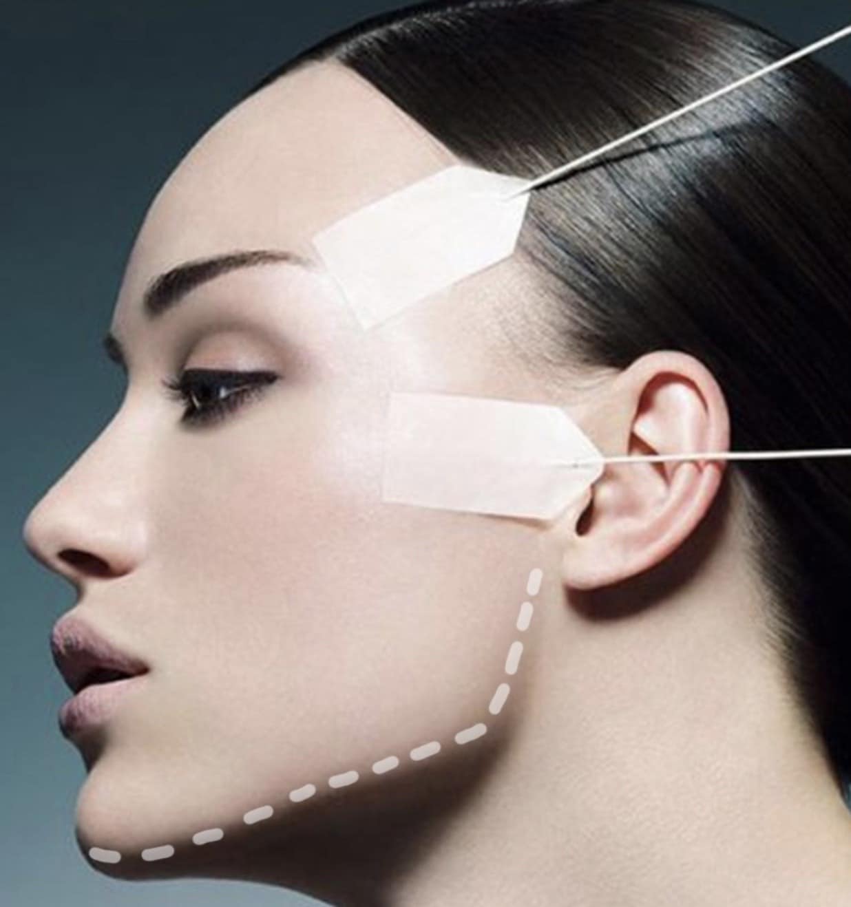 PDO İplerle Yüz Germe | 2025 Fiyatları - Op. Dr. Leyla Arvas