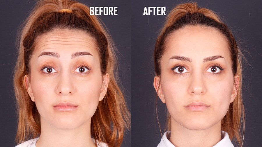 Botox - Price - Istanbul, Turkey - Op. Dr. Leyla Arvas