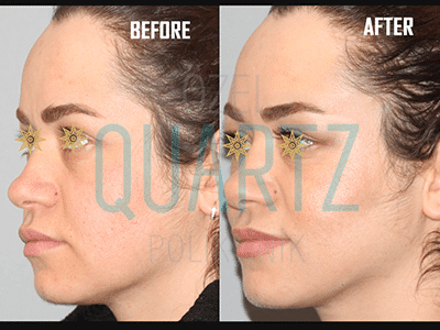 Thread Lift - Price - Istanbul, Turkey - Op. Dr. Leyla Arvas