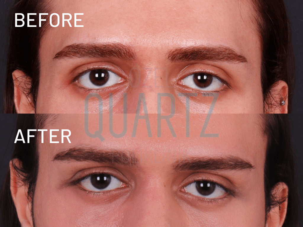 Foxy Eyes Lifting (Kanthoplastik) - Kosten- Istanbul,Türkei- Op. Dr ...