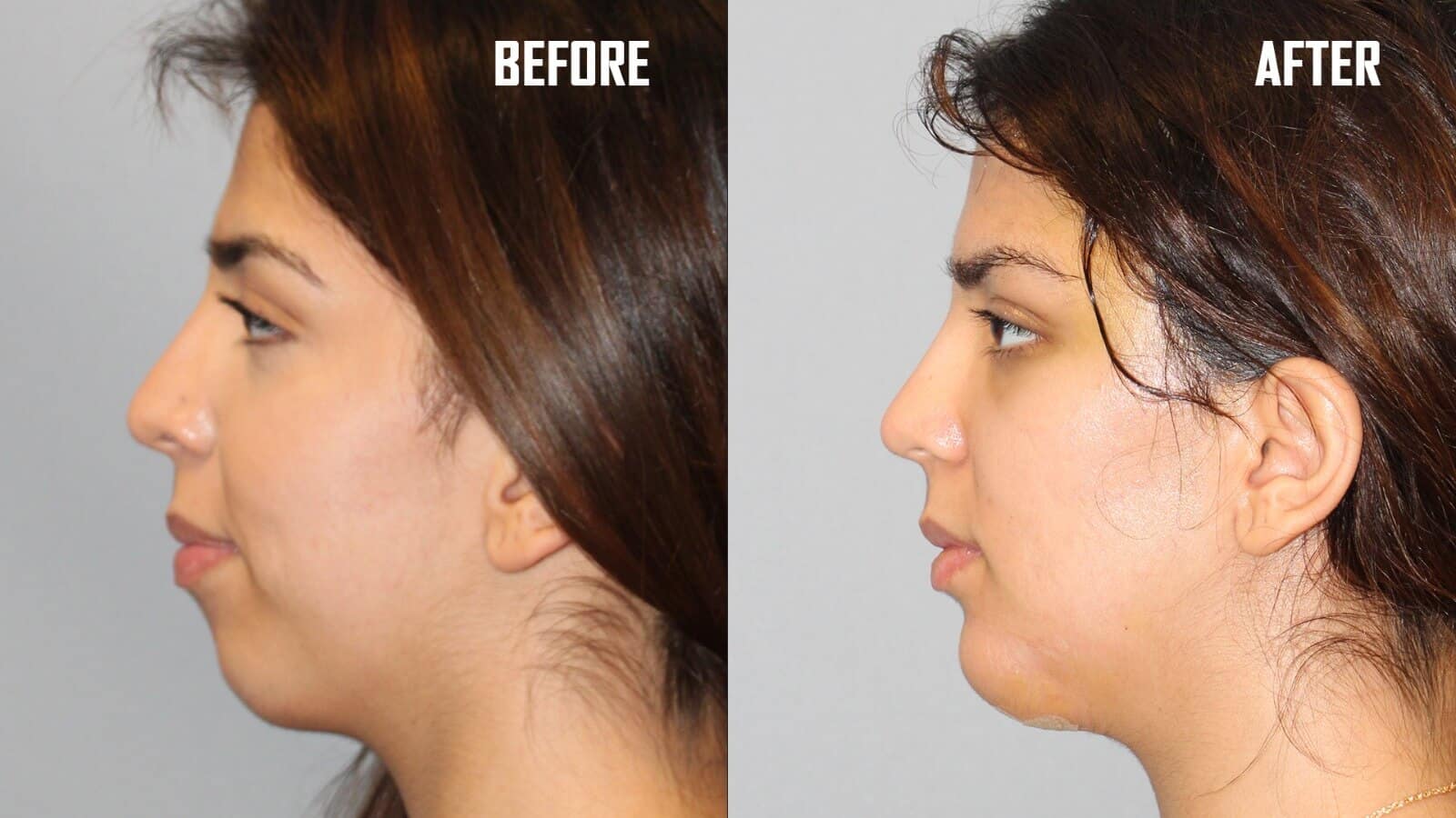Chin Augmentation - Op. Dr. Leyla Arvas