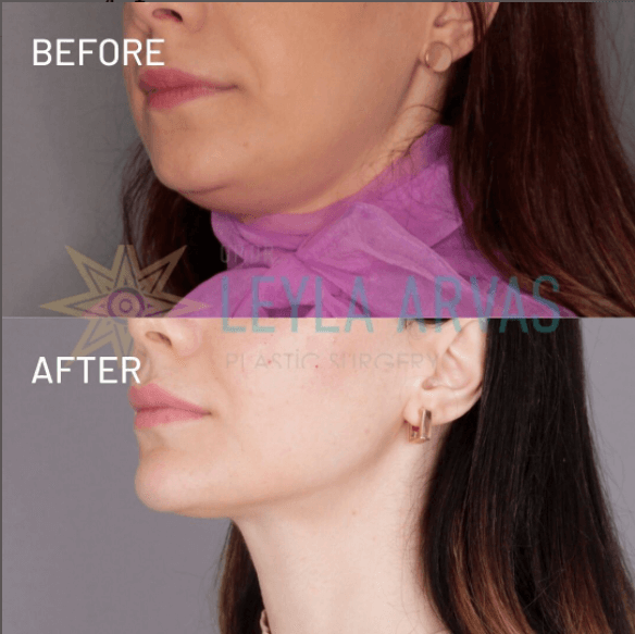 Jawline Contouring with Dermal Fillers - Price - Istanbul, Turkey - Op ...