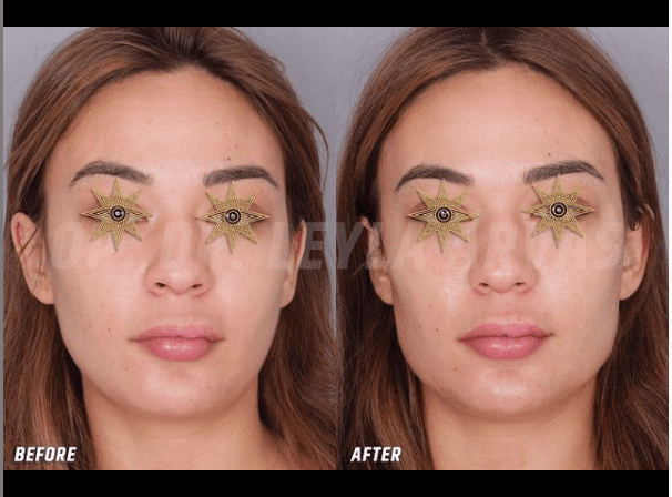 Jawline Contouring with Dermal Fillers - Price - Istanbul, Turkey - Op ...