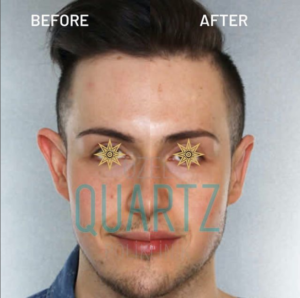 Prominent Ear FAQs: I Wish I Knew Before Getting It - Op. Dr. Leyla Arvas