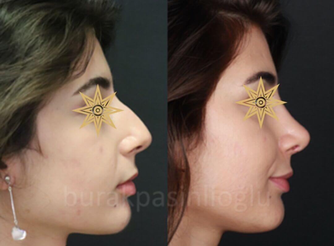 Rhinoplastik (Nasenkorrektur) - Kosten- Istanbul,Türkei- Op. Dr. Leyla ...
