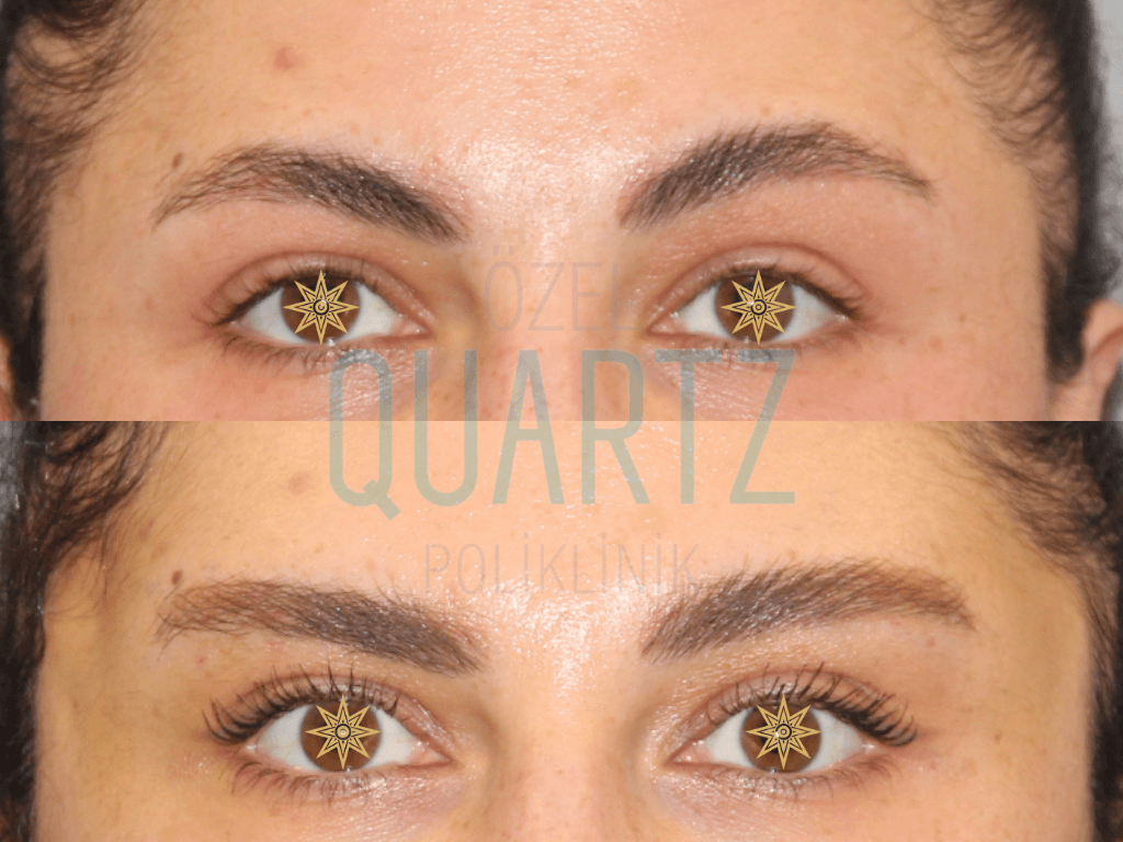 Foxy Eyes Lifting (Kanthoplastik) - Kosten- Istanbul,Türkei- Op. Dr ...